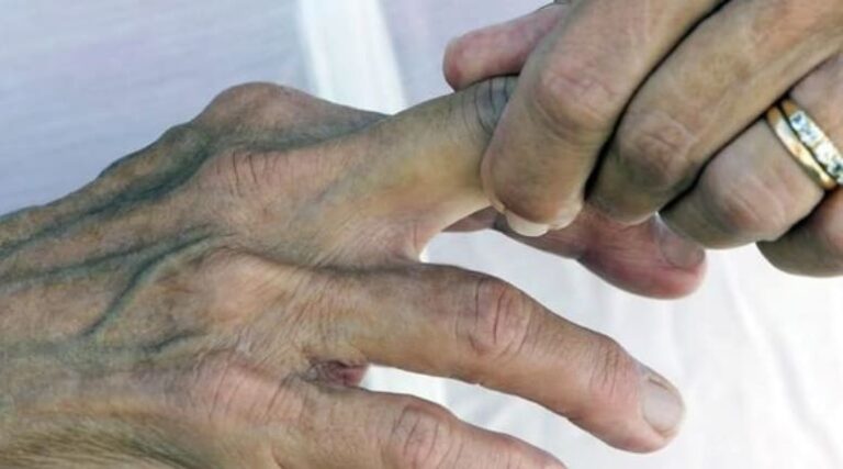 Signs of a Jammed Finger and the Ultimate Guide to Treatment ...